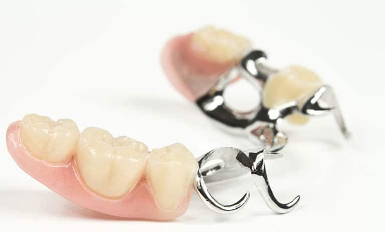 Modellgussprothesen - Zahnarztpraxis Dr. Eva Menninger-Stöss